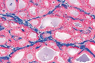 Slide, Thyroid, sec.